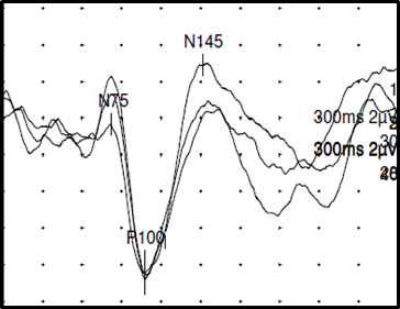 UTILITA’ DEI MULTIFOCAL VEP - ACeSM Onlus
